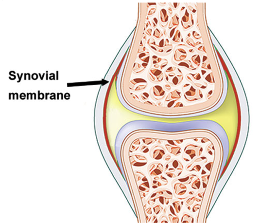 Acupuncture in the Management of Synovitis and inflammation